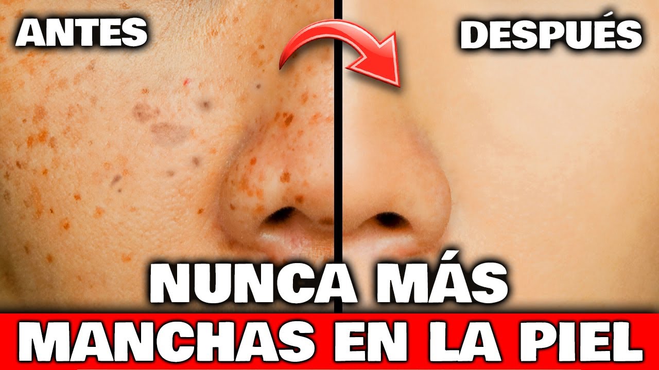 5 efectivos remedios caseros para quitar las manchas oscuras de acné - Todo sobre Cuidado Infantil