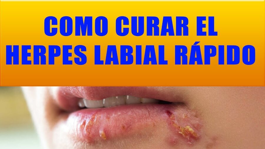 5 efectivos remedios caseros para eliminar los herpes de la boca de forma natural - Todo sobre ...